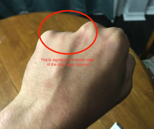 Case Study About A CFL Offensive Lineman’s Broken Hand Recovery