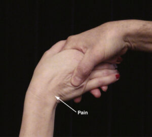 Wrist Pain: TFCC Injury Help | Kitchener & Waterloo