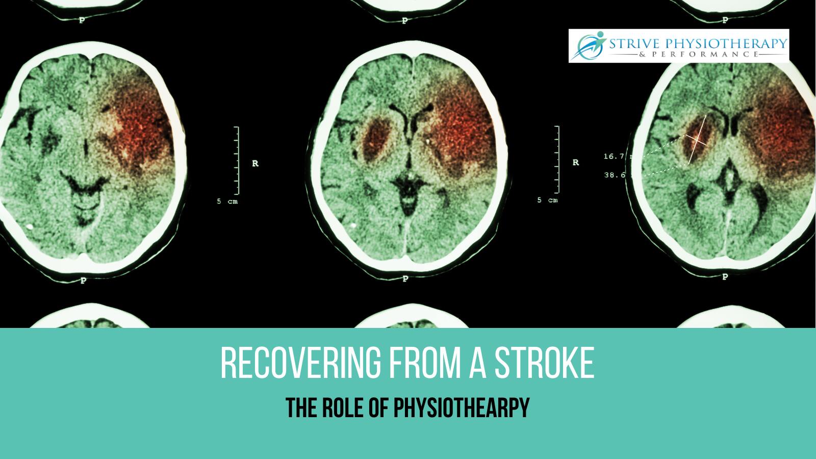 Recovering from Stroke: The Role of Physiotherapy